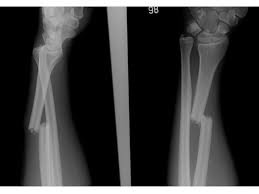 Naming Fractures – Teaching to the Test – PANCE/PANRE preparation site